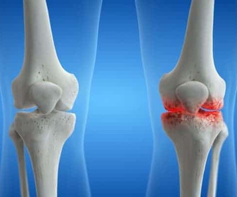 Inflammation : symptômes, bénéfices et risques
